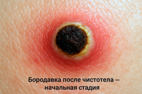 Чистотел от бородавок — как применять, что важно знать, инструкция и ...